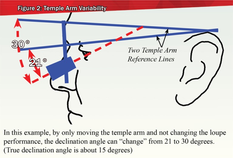 Demystifying Declination Angle - SurgiTel Ergonomic Loupes